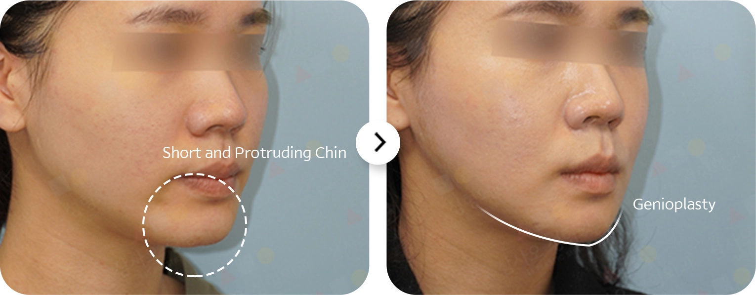 Genioplasty Enhance Your Chin For Balanced Facial Harmony
