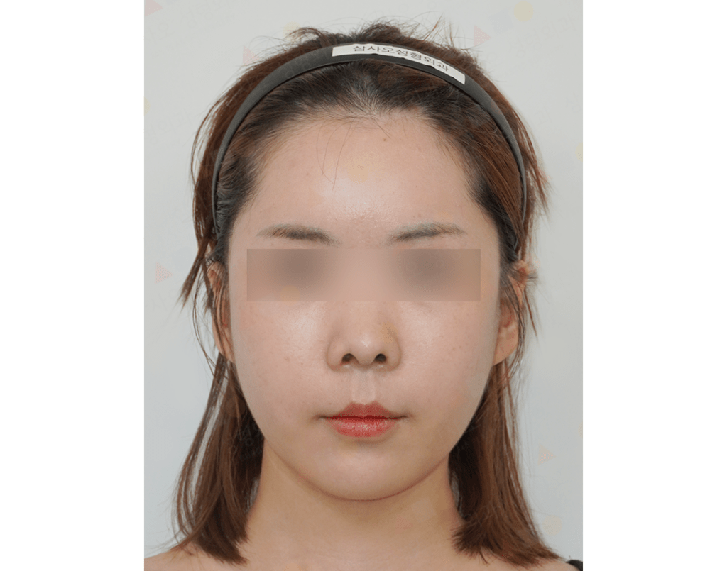 Minimal Incision Lifting for Youthful Skin